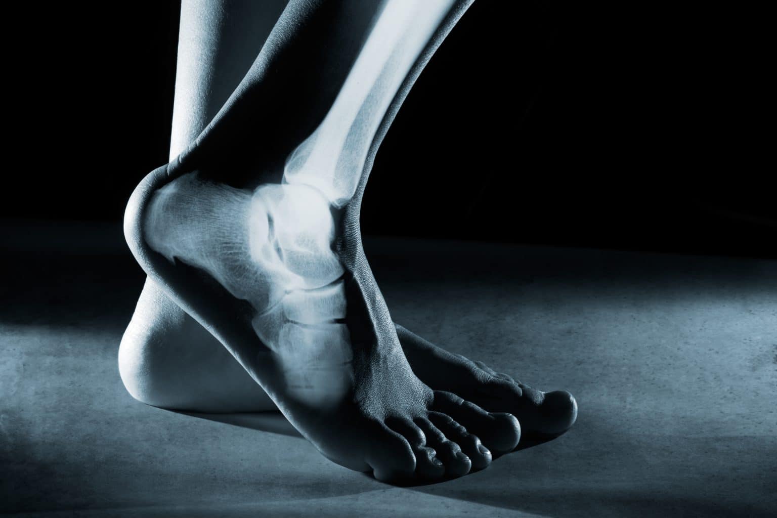Enkel fractuur/gebroken enkel | AHC Fysiotherapie